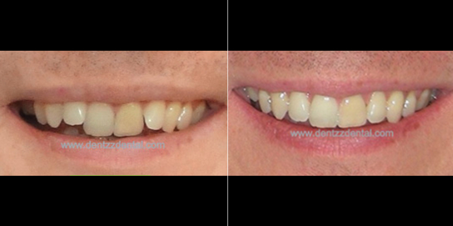 Invisible braces | Clear dental braces | Teeth braces | Dentzz Dental